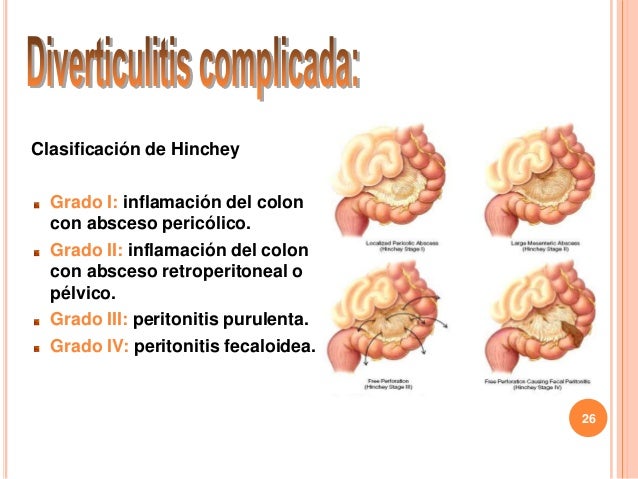Patologia benigna del colon enfermeda diverticular, diverticulitis, D…