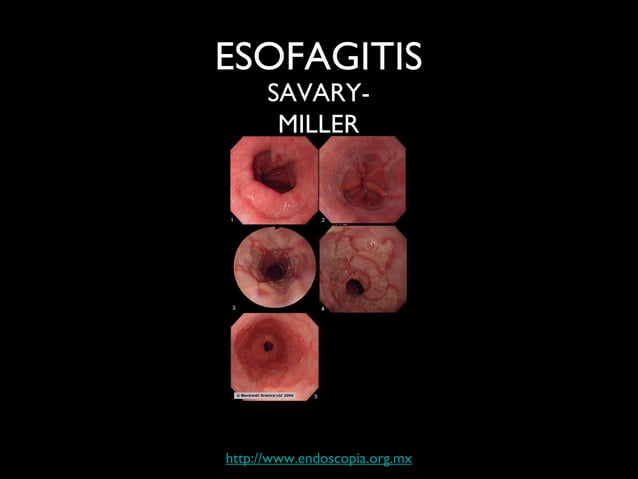 Patologia benigna esofago 2 | PPT