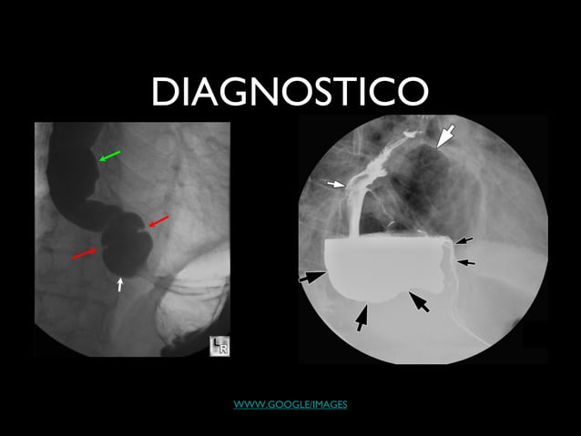Patologia benigna esofago 2 | PPT