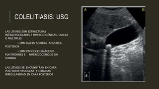 PATOLOGIA BILIAR, colelitiasis, colangitis | PPTX