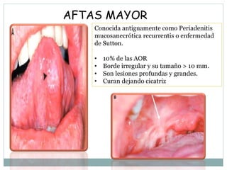 Patología bucal y glándulas salivales (Otorrinolaringologia) | PPTX