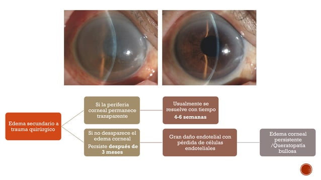 PATOLOGIA CORNEAL edema de cornea y quemadura corneal | PPT