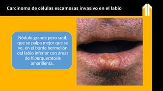 CANCER CUTANEO DE PIEL NO MELANOME Y MELANOMA CON SUB TIPOS BASOCELULAR ...