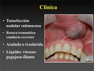 PATOLOGIA DE GLANDULAS SALIVALES 2024.PPT