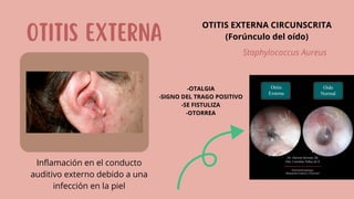 PAtología otitis externa medias interna | PDF