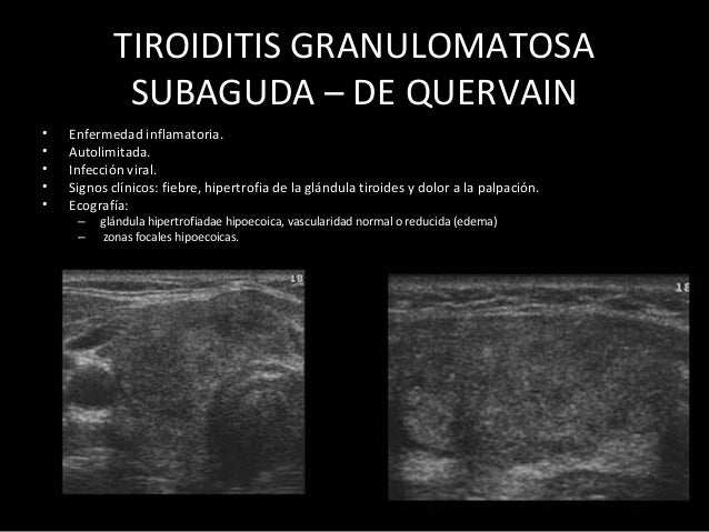 Patología de la glándula tiroidea en ecografia