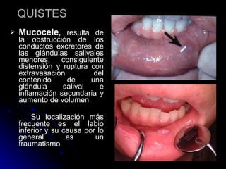 Patologia de las glandulas salivales | PPT