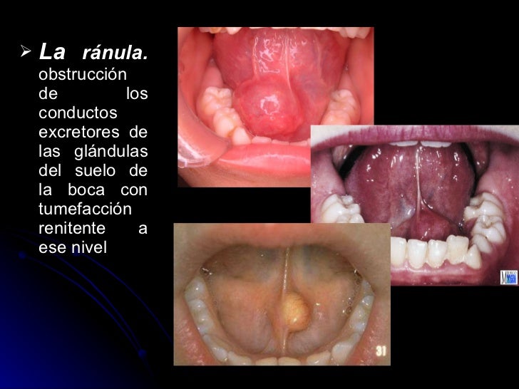 Patologia de las glandulas salivales Patologia de las glandulas salivales