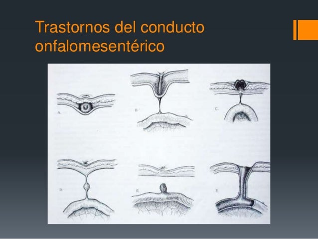 Patologia del cordon y persistencia del uraco PEDIATRIA