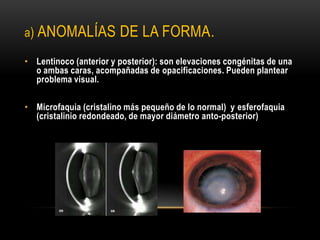 Patologia del cristalino | PPTX