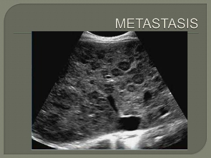 ecografia lesiones hepàticas