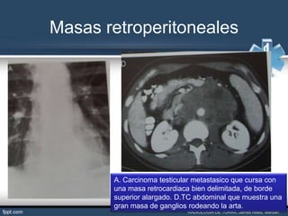 Patologia del mediastino posterior | PPTX