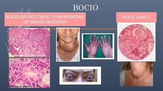 Patología endocrina | PPTX