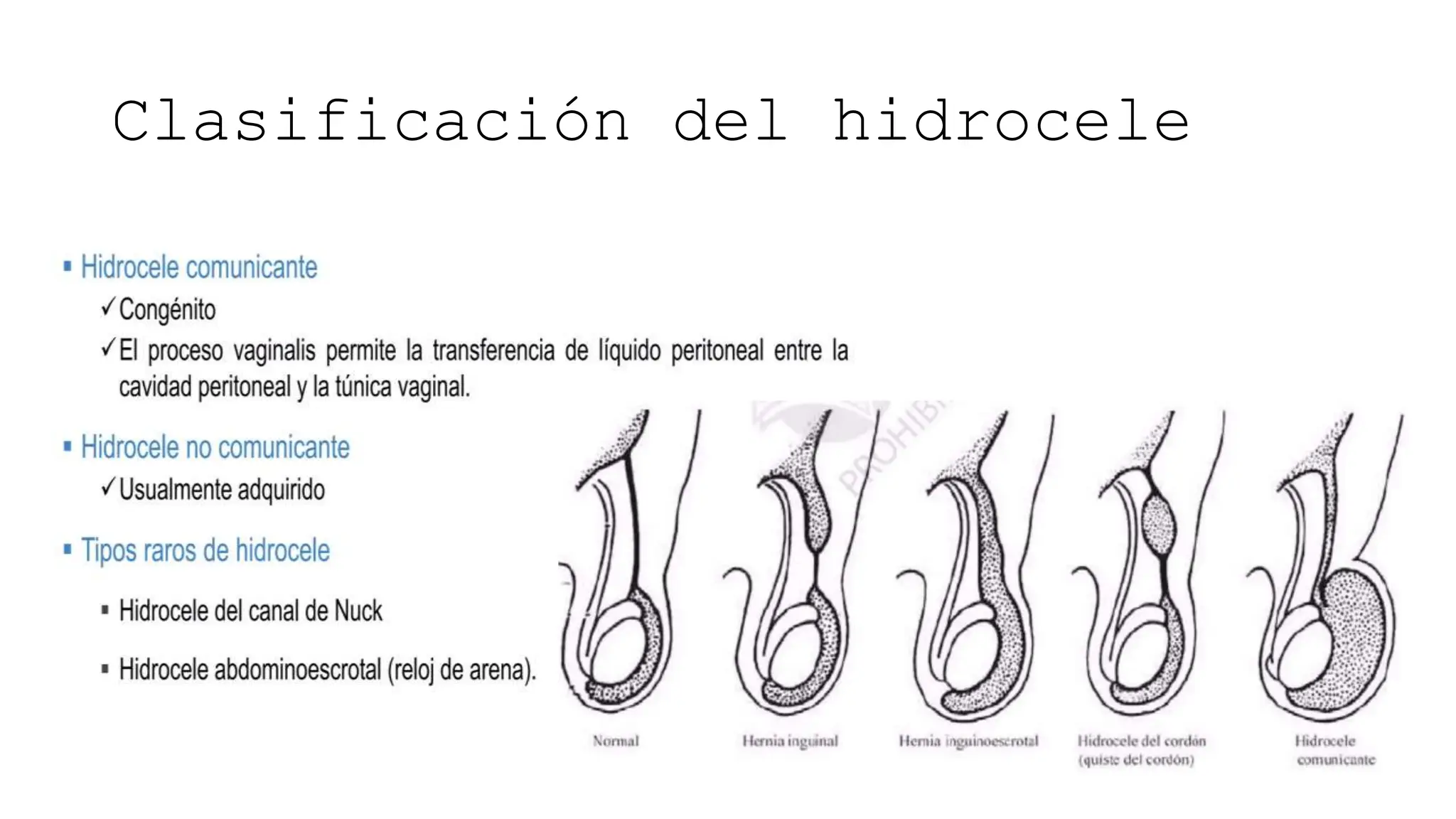 patologia escrotal: Varicocele e hidrocele | PPT