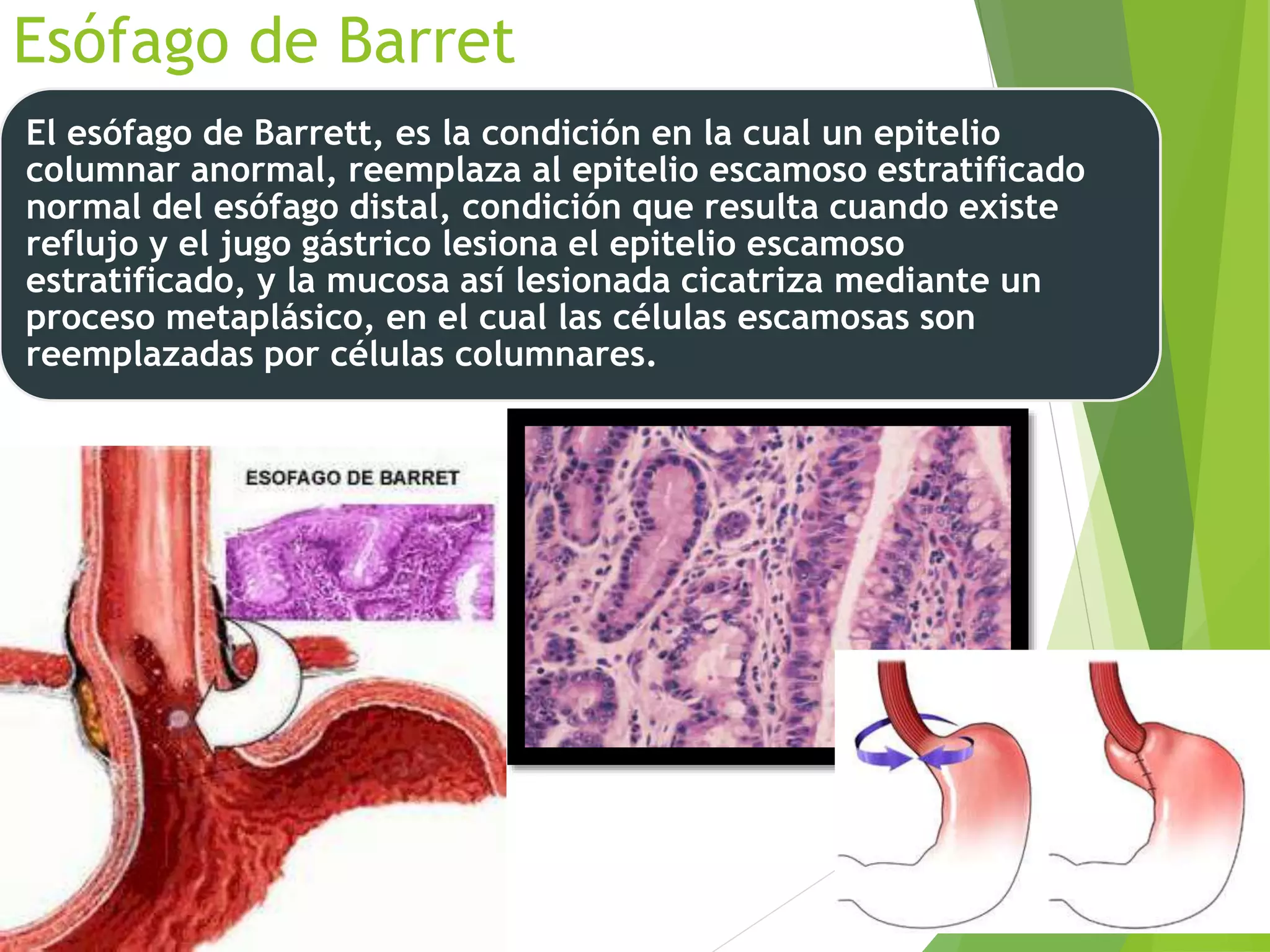 Patologia esofago | PPTX
