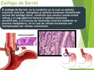 Patologia esofago | PPTX