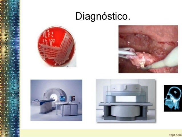 gangrena de fournier