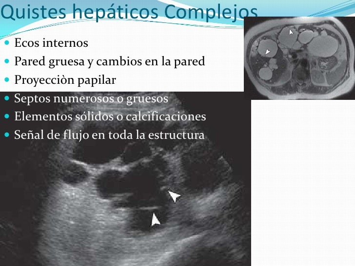 Ecografìa de las lesiones hepàticas benignas