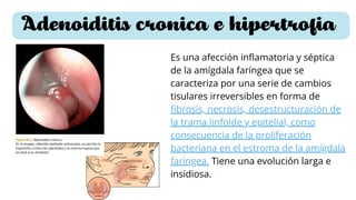 Patologia infecciosa e inflamatoria de faringe y laringe .pdf