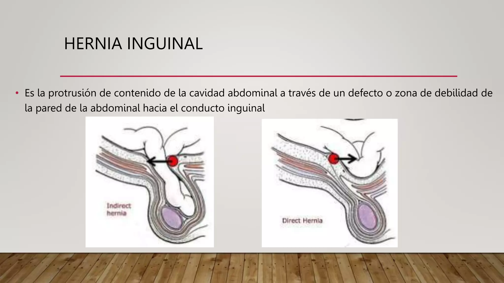 Patología inguinal.pptx