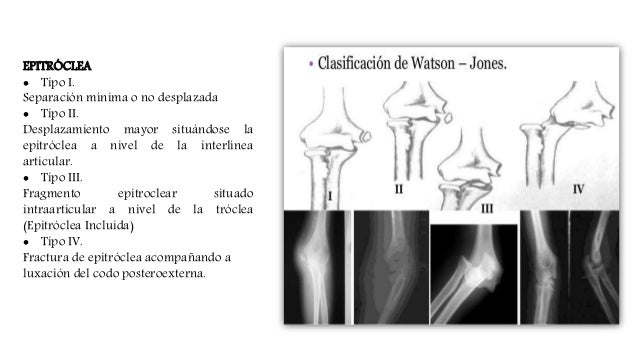 Patologia, luxaciones y fracturas del codo