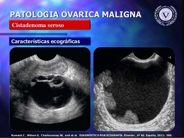 Patologia maligna de ovario