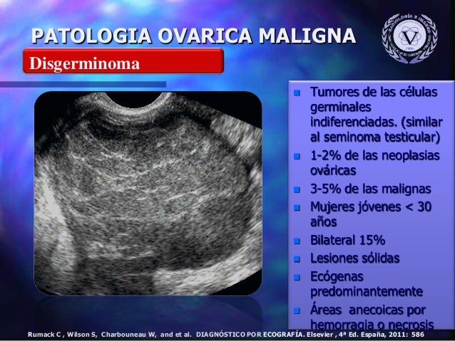 Patologia maligna de ovario