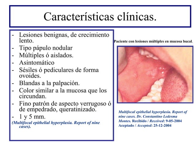 Patologia oral infección papiloma humano | PPT