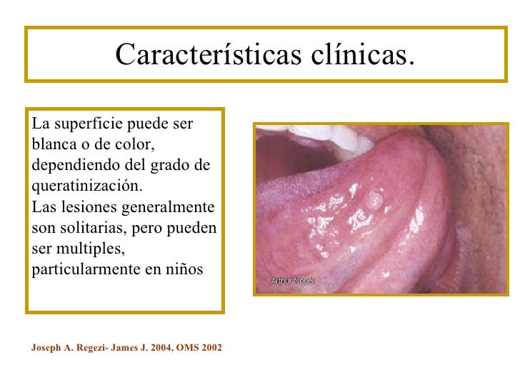 Patologia oral infección papiloma humano