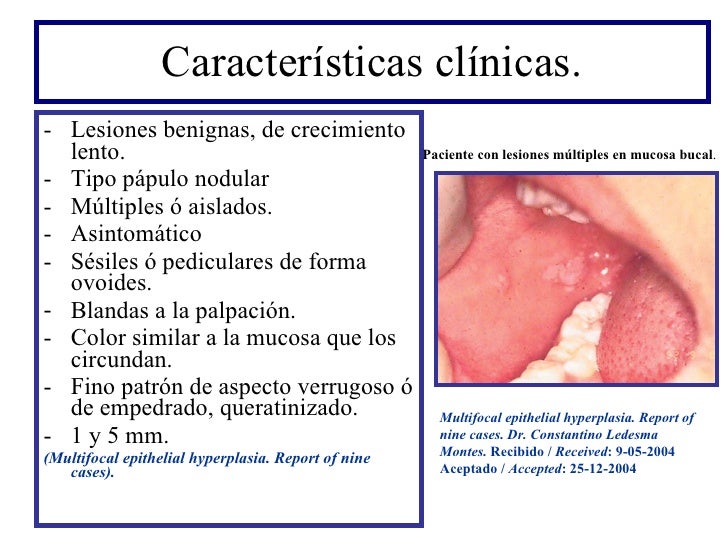 Patologia oral infección papiloma humano