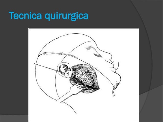 Patologia Quirurgica de Parotida