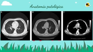 Patologia respiratoria-Tuberculosis .pptx