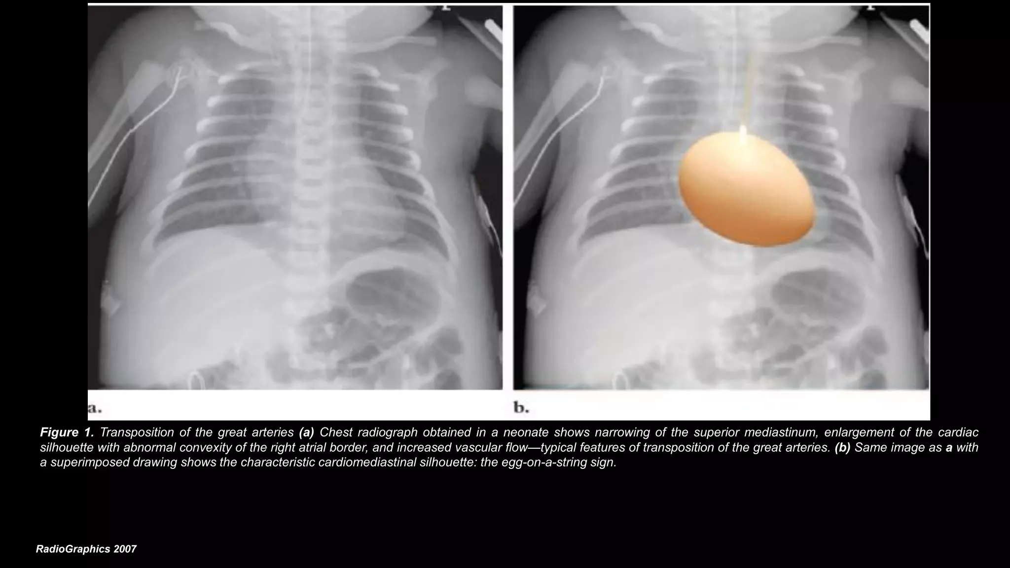 Patologia rx tc rmn cardiopatias congenitas 2018 | PDF