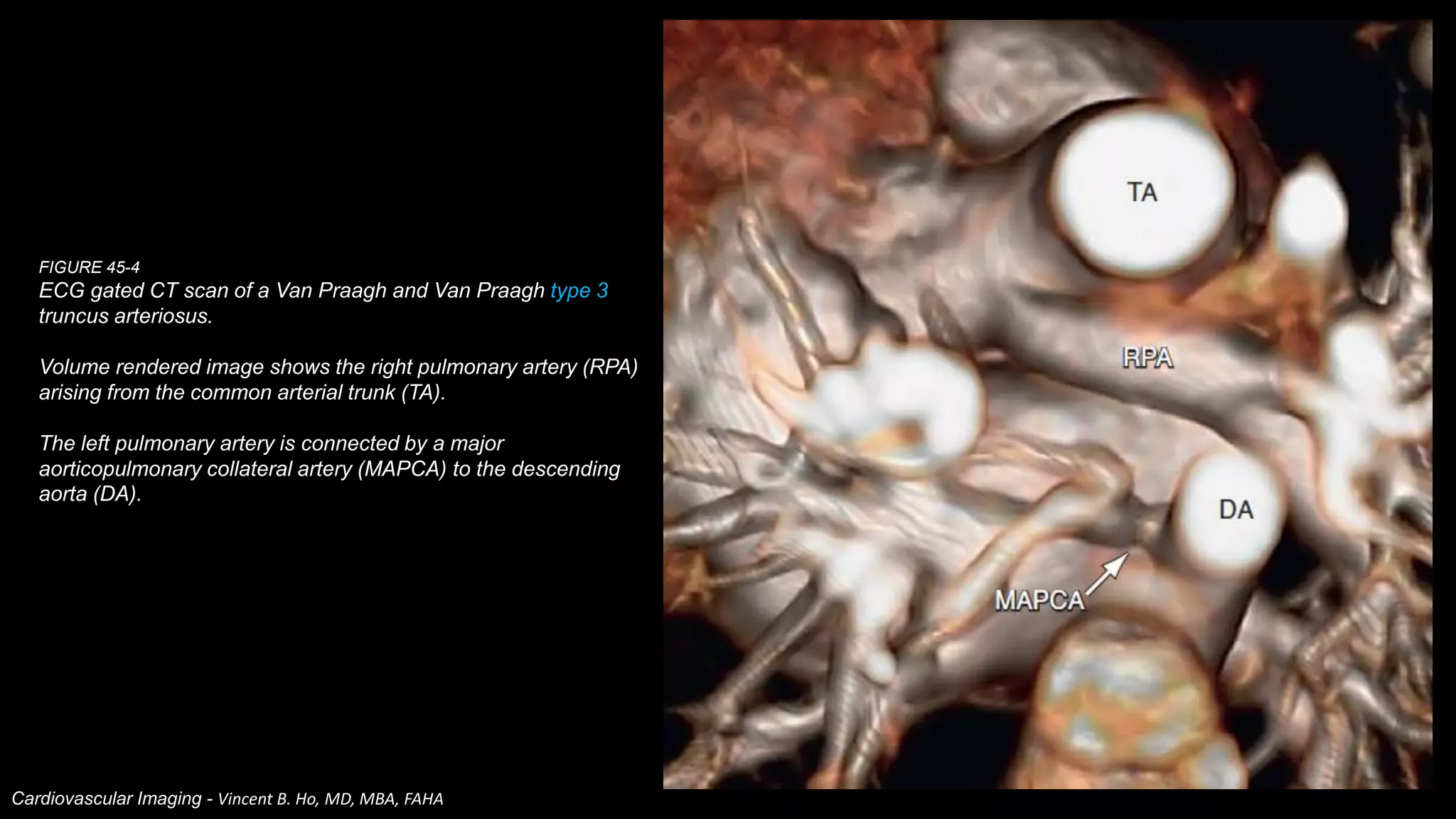 Patologia rx tc rmn cardiopatias congenitas 2018 | PDF