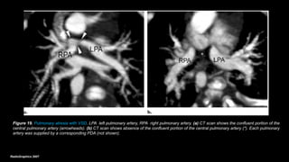 Patologia rx tc rmn cardiopatias congenitas 2018 | PDF