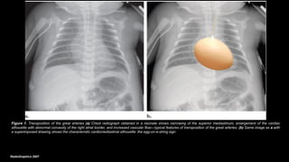 Patologia rx tc rmn cardiopatias congenitas 2018 | PDF
