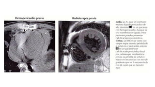 Patologia rx tc rmn enfermedades del pericardio | PDF