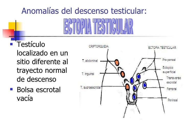 CRIPTORQUIDIA Y ECTOPIA TESTICULAR PDF