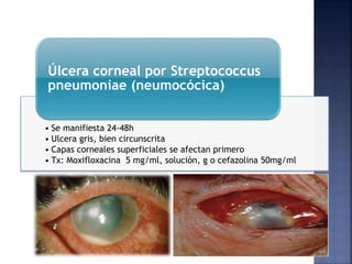 ulceras corneales bacterianas | PPTX