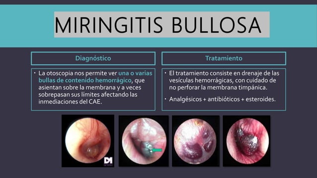 Derrame Da Membrana Timpanica