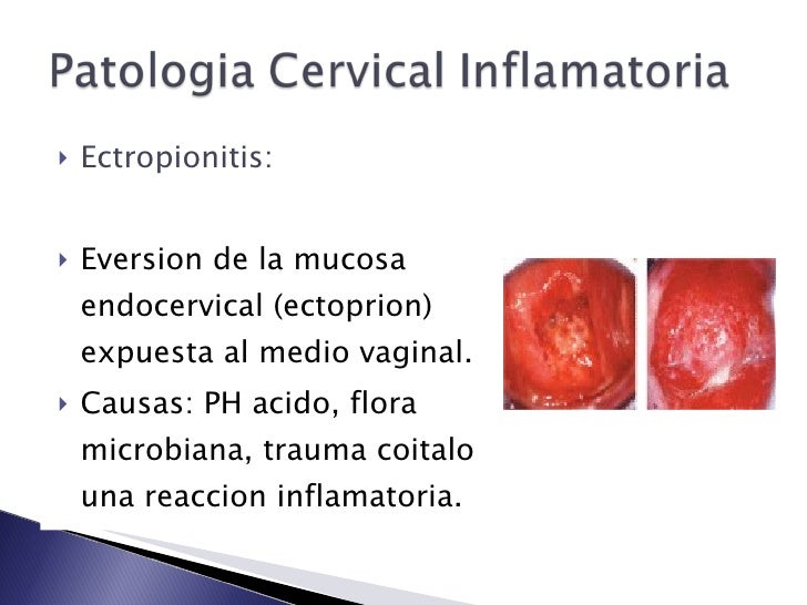 Patologias del cervix