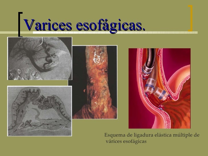 Patologias del esofago