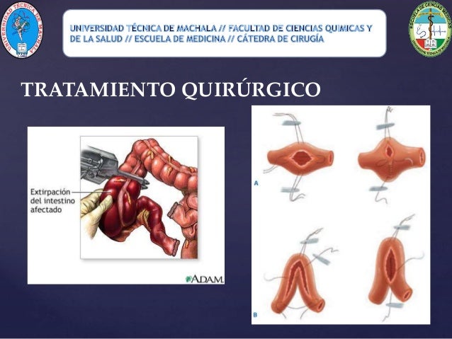 CIRUGÍA: Patologias del intestino delgado