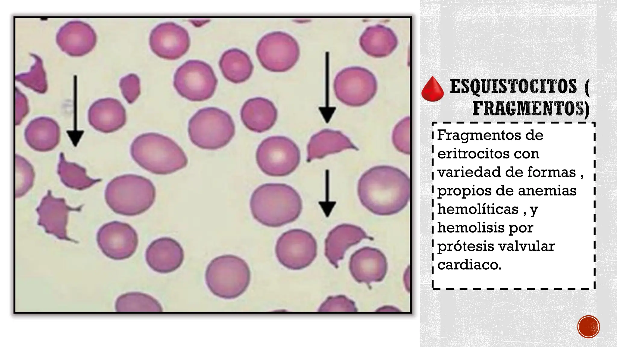 Patologías de los eritrocitos-Histologia.pptx | PDF