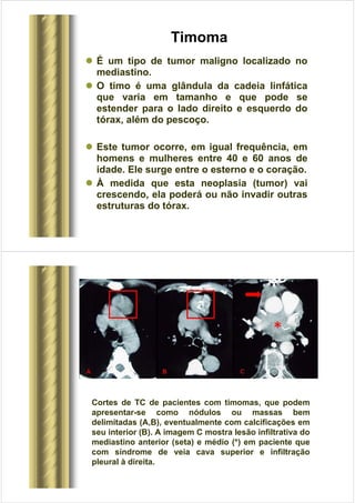 Patologias do tórax | PDF