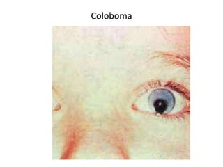 Patologias embriologicas de ojo | PPTX