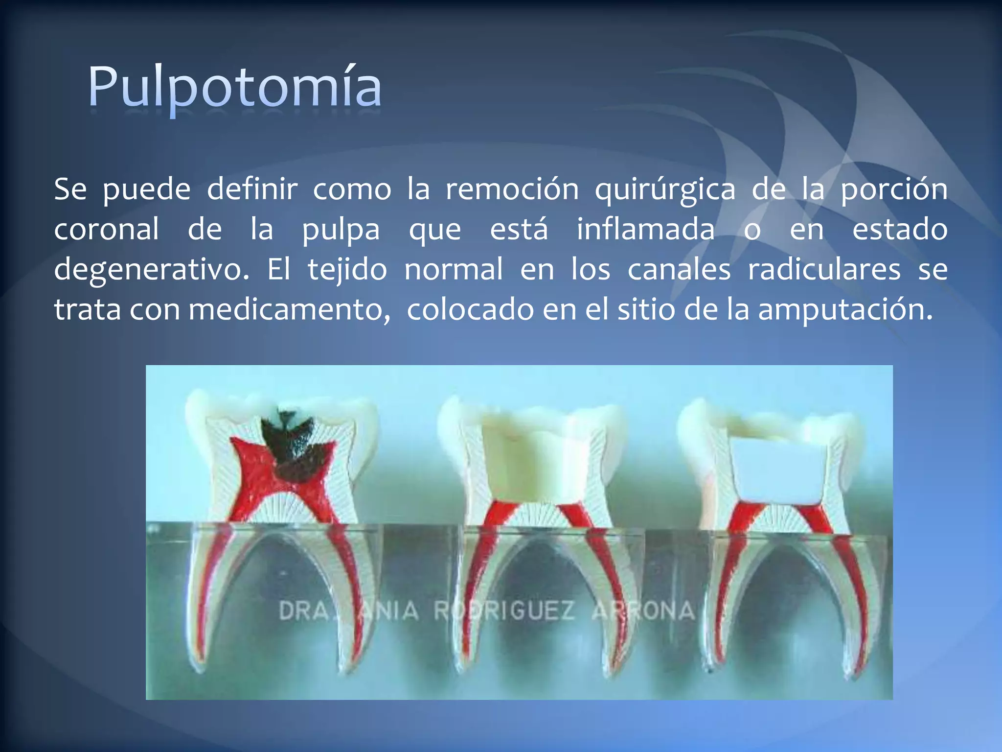 Patologias pulpares | PPTX