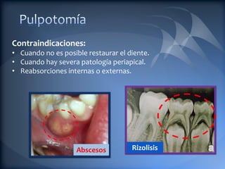 Patologias pulpares | PPTX