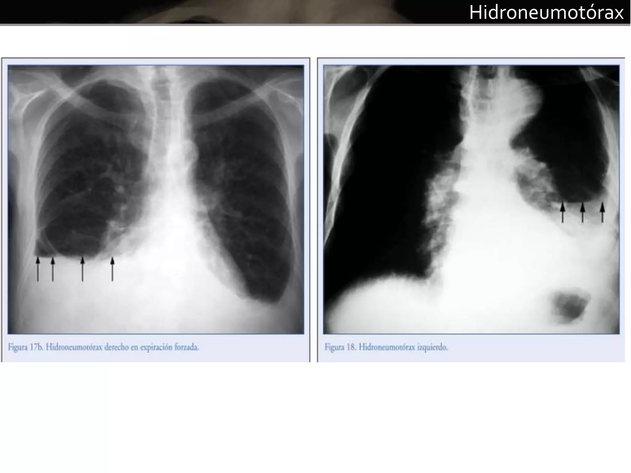 Patologias radiologicas de torax | PPTX | Lung and Respiratory Health ...