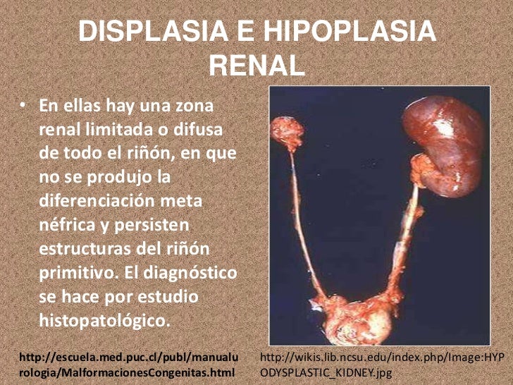 Patologias renales y genito urinarias mas frecuentes en